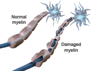 Infusions Explained - Abington Neurological Associates